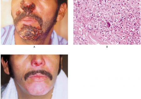 Herpes simple, infección severa.png :: www.documentosmedicos.com
